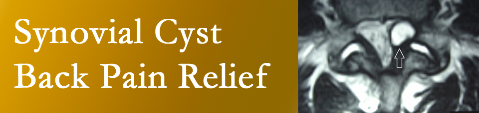Fort Wayne Chiropractic Relieves Back Pain Related to Synovial Cyst ...